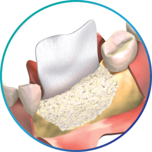 Bone Grafting | Flower Mound, Texas | Denton, Texas