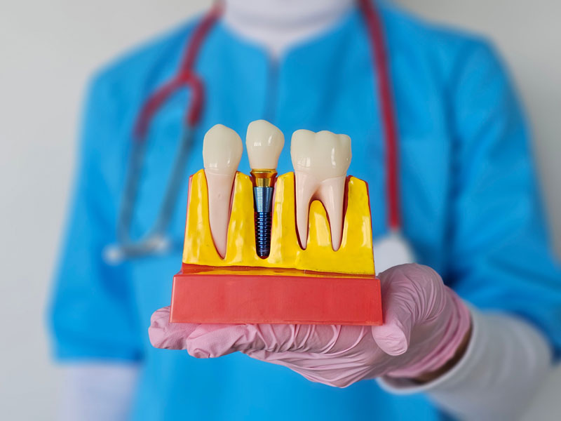 Exploring Your Options: Different Types of Dental Implants for a ...