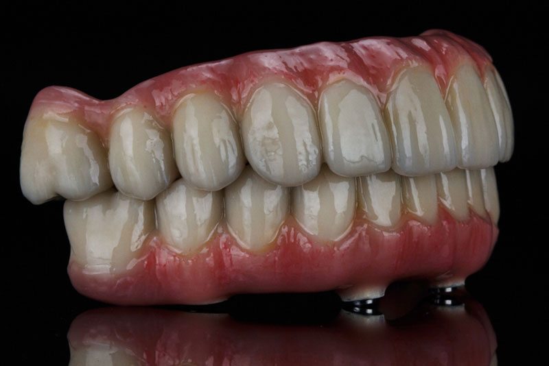 Transform Your Smile with Full Arch Dental Implants in Dallas TX: A ...